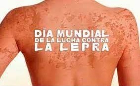 Día Mundial Contra la Lepra - Infomed Santiago