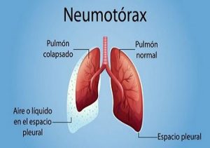 Neumotórax: una guía para la práctica - Infomed Santiago